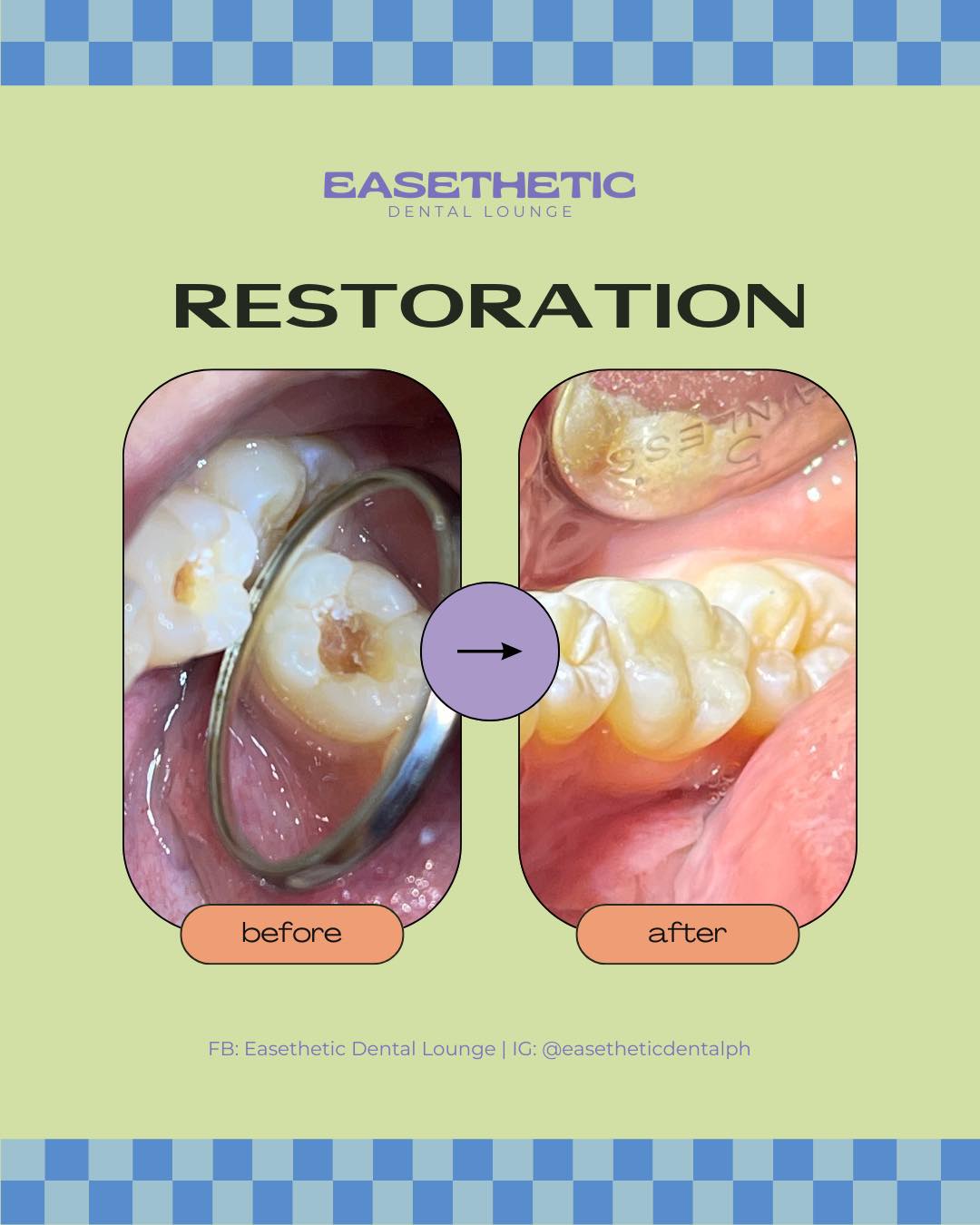 Tooth Filling (Pasta) | Cavity Repair | Easethetic Dental QC ...