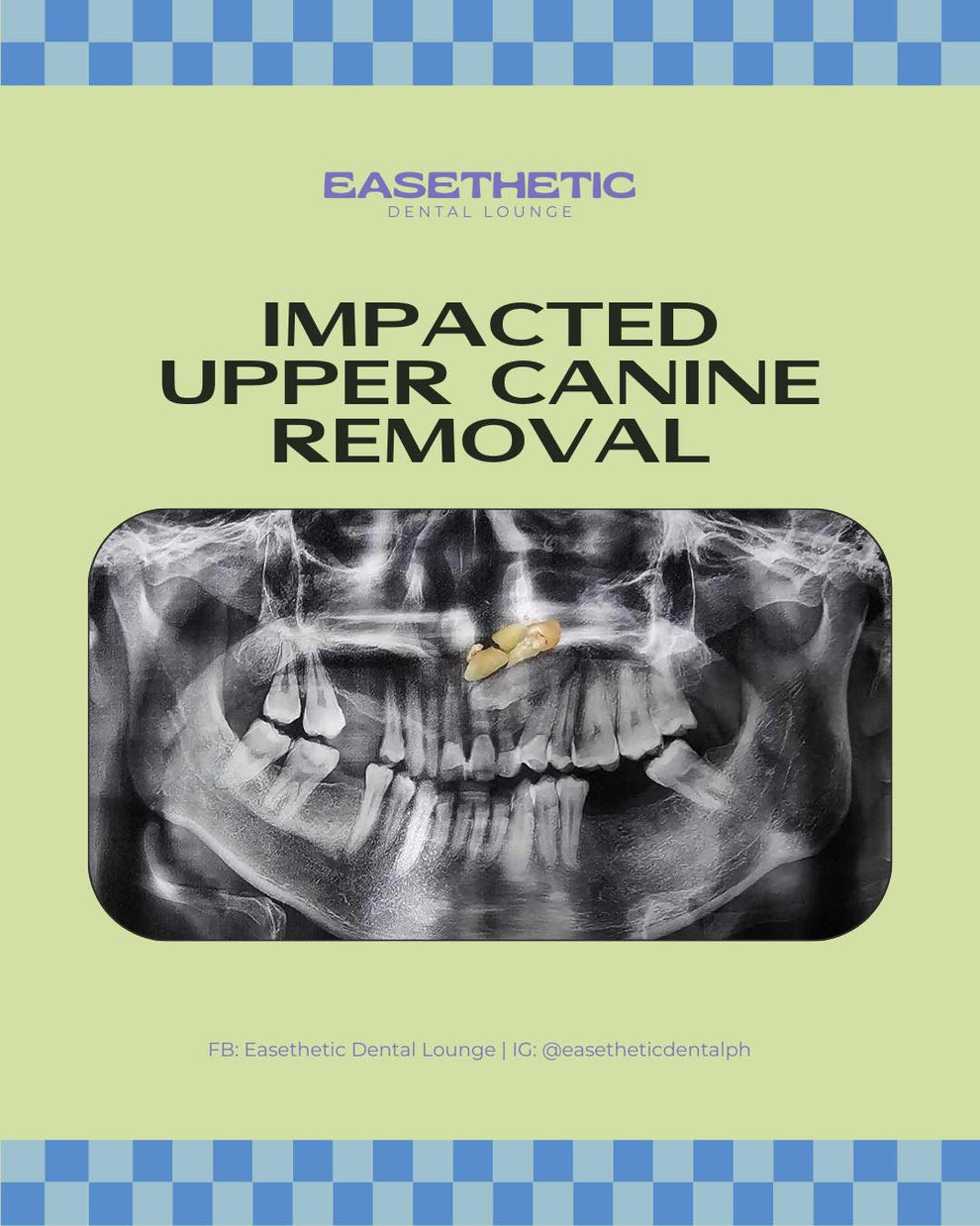 Canine Exposure Surgery | Impacted Tooth Treatment | QC – Easethetic ...