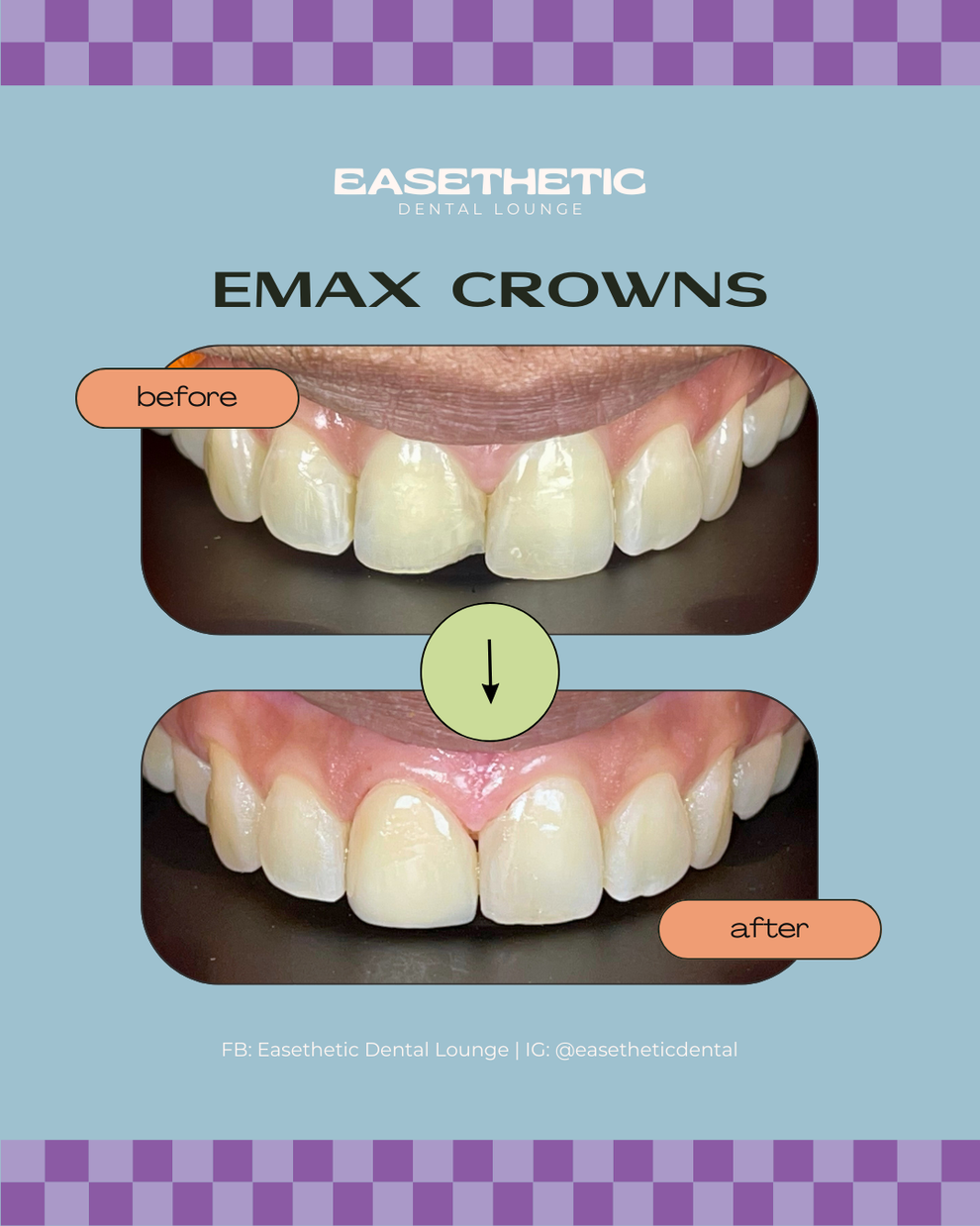 Emax Crowns | Natural-Looking Dental Crowns | Quezon City – Easethetic ...
